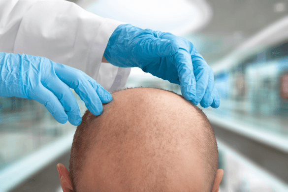 Everything You Need to Know About The NeoGraft Hair Transplant ...
